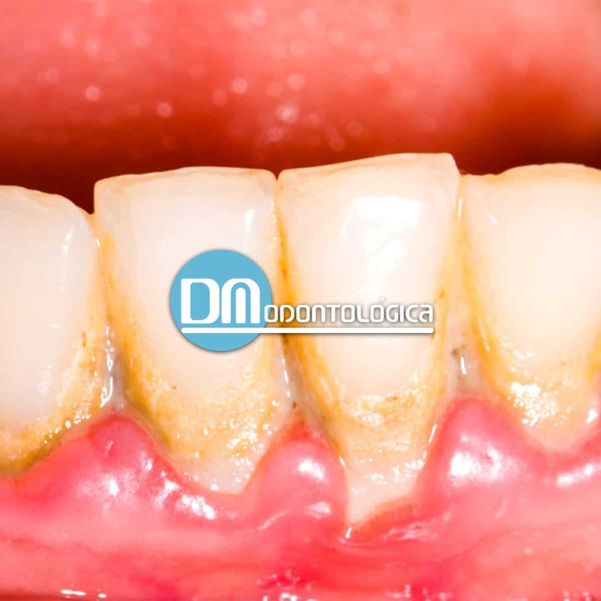Sarro en los dientes - DM Odontológica