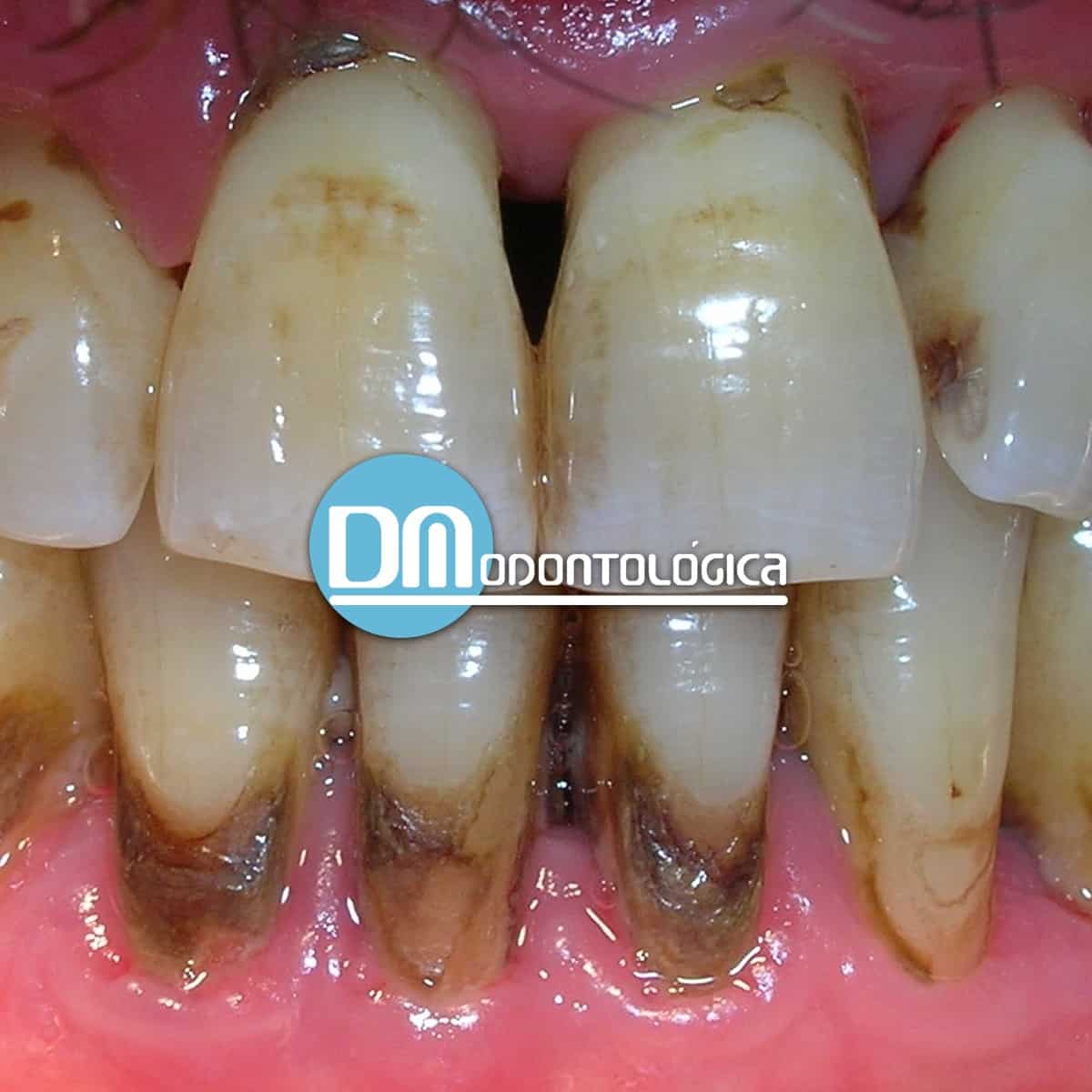 Cálculo Dental – DM Odontológica